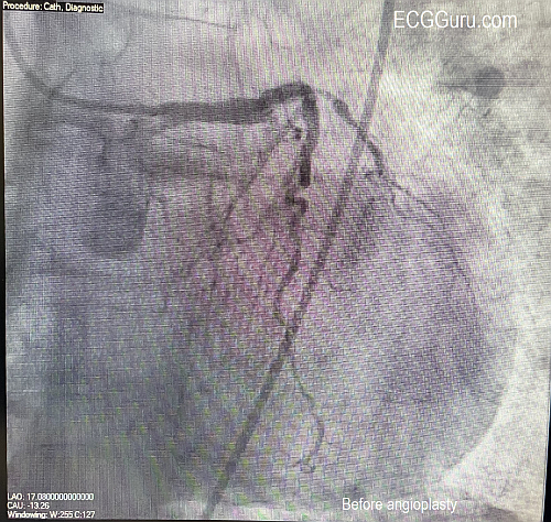 Instructors' Collection ECG: Acute Occlusive Myocardial Infarction With Cardiogenic Shock | ECG ...